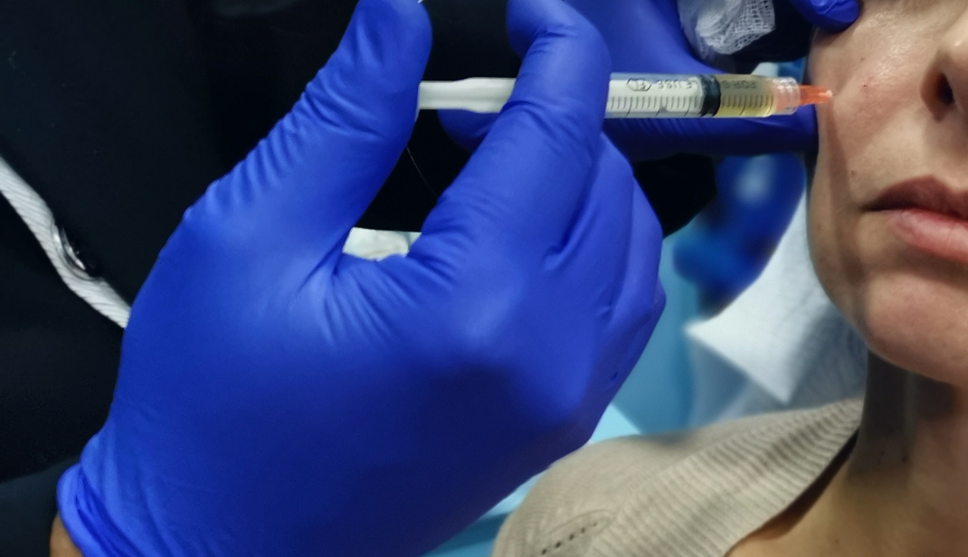 Τι συνέβη όταν έκανα για πρώτη φορά PRP -Οι ρυτίδες εξαφανίστηκαν μέσα ...