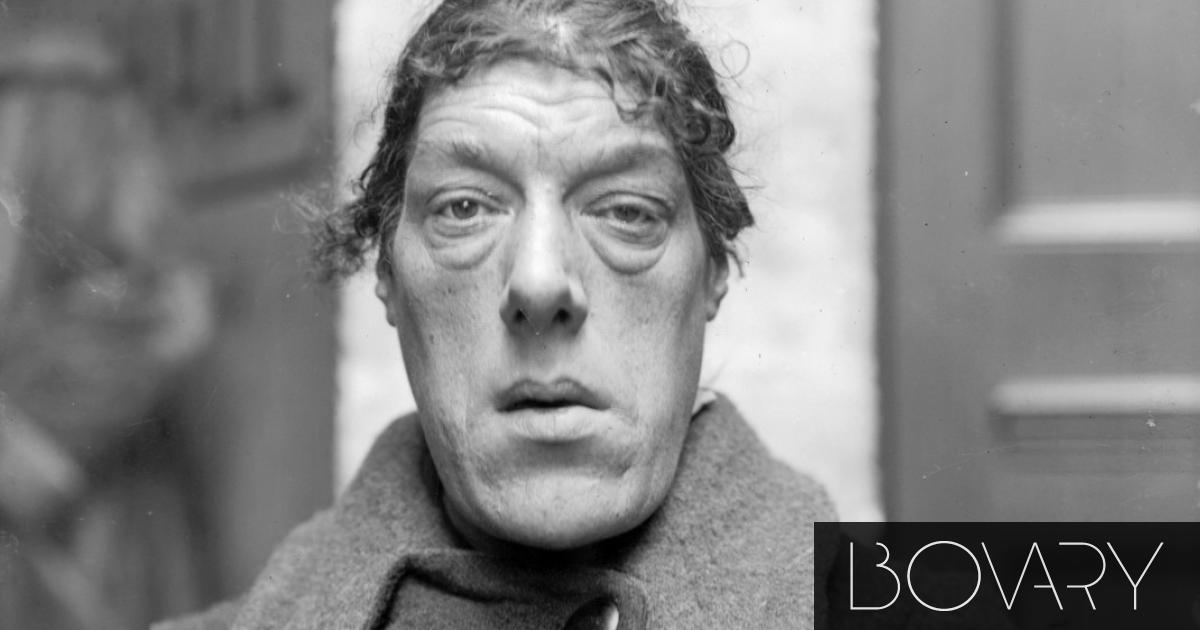 Mary Ann Bevan: Η τραγική ιστορία της «πιο άσχημης γυναίκας του κόσμου ...