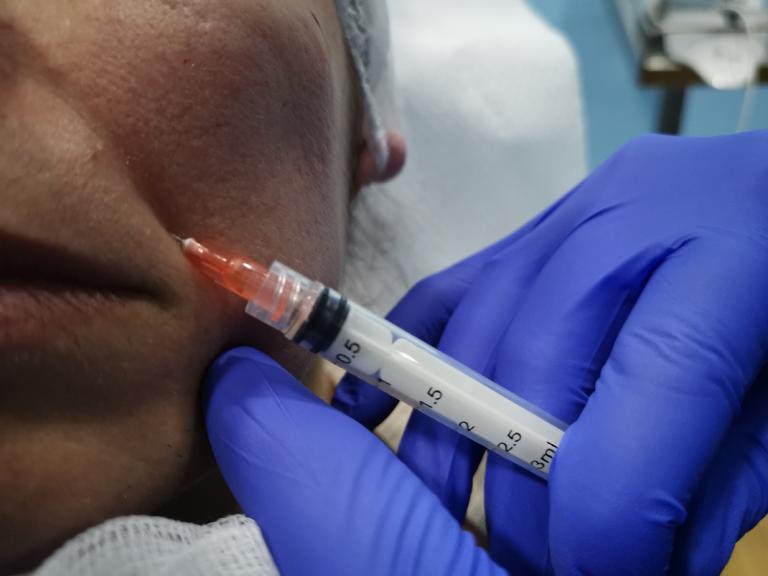 Τι συνέβη όταν έκανα για πρώτη φορά PRP -Οι ρυτίδες εξαφανίστηκαν μέσα ...